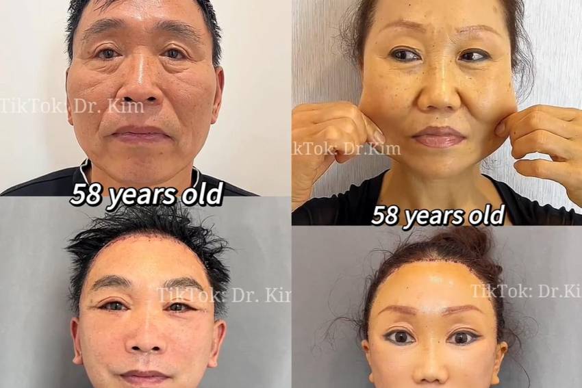 Se viralizan cirugías del ‘Dr. Kim’ por el perturbador resultado de sus ...