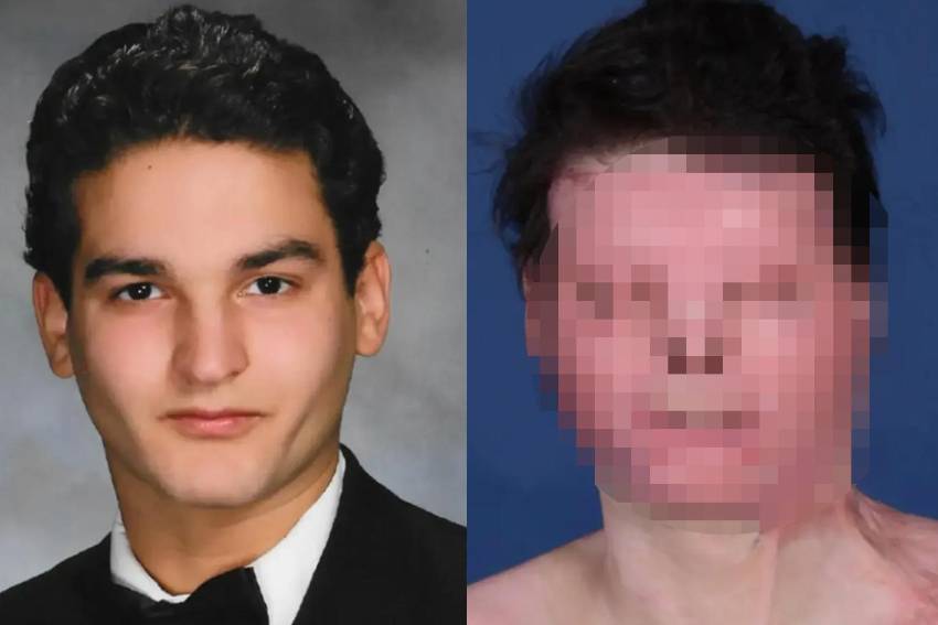 Así luce Joe, un joven que sobrevivió a un trasplante de rostro y que ...