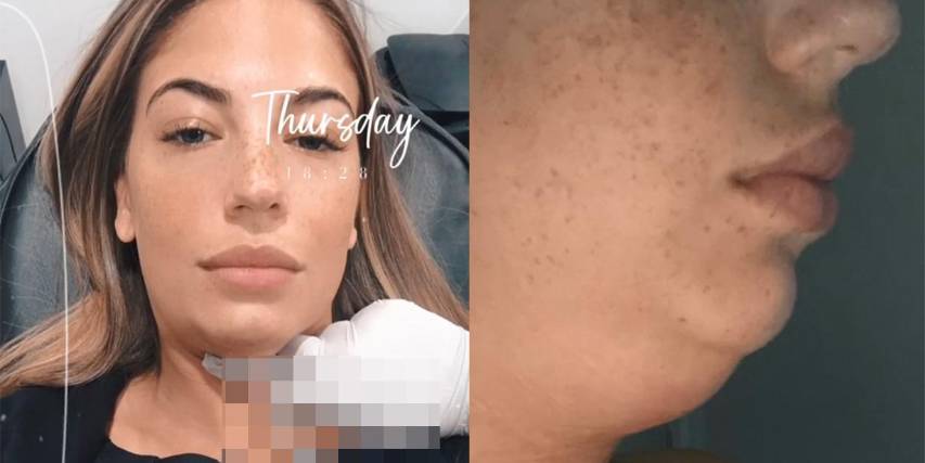 Viral: Mujer muestra el fallido resultado estético para reducir su “papada”